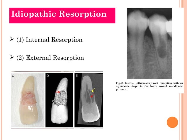 Abnormalities of the pulp | PPT | Dental Health | Diseases and Conditions