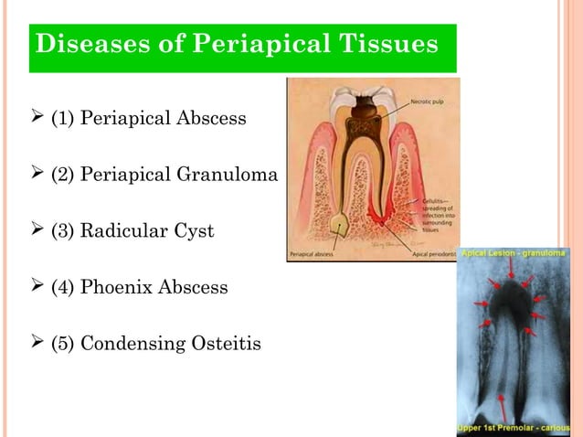 Abnormalities of the pulp | PPT | Dental Health | Diseases and Conditions