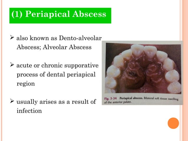 Abnormalities of the pulp | PPT | Dental Health | Diseases and Conditions