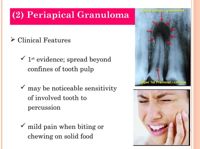 Abnormalities of the pulp | PPT | Dental Health | Diseases and Conditions