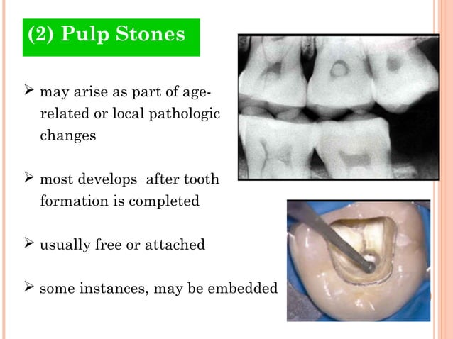 Abnormalities of the pulp | PPT | Dental Health | Diseases and Conditions