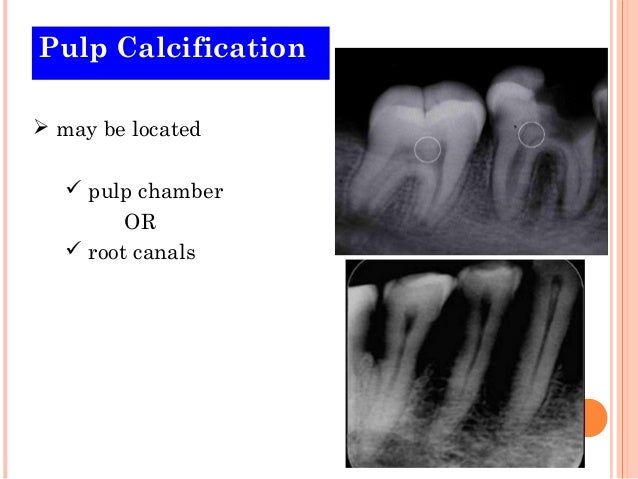 Abnormalities of the pulp