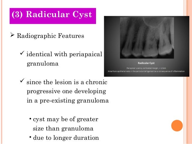 Periapical Granuloma Vs Cyst Oral Pathology Radiology (UBSDM)