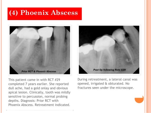 Abnormalities of the pulp