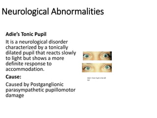 Abnormalities of the Pupil.pptx