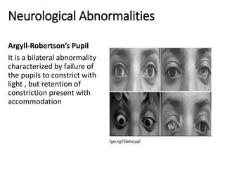 Abnormalities of the Pupil.pptx