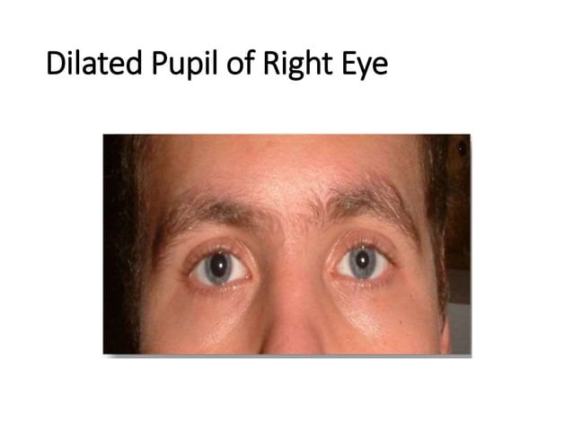 Abnormalities of the Pupil.pptx