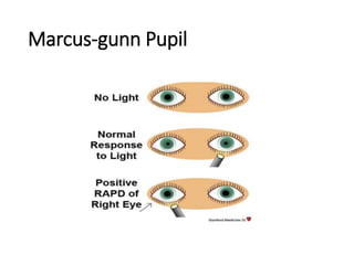 Abnormalities of the Pupil.pptx