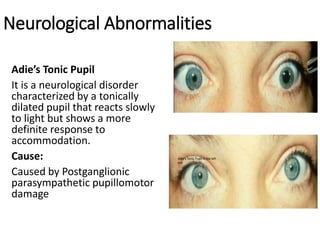 Abnormalities of the Pupil copy copy copy.pptx