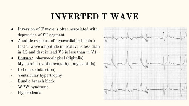 Abnormalities of t wave | PPTX
