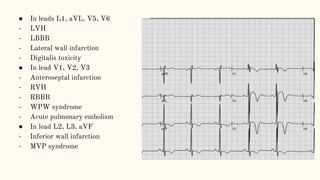 Abnormalities of t wave | PPTX