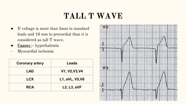 Abnormalities of t wave | PPTX