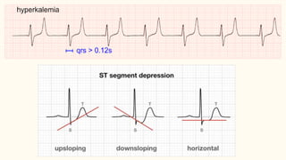 Abnormalities of t wave | PPTX