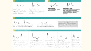 Abnormalities of t wave | PPTX