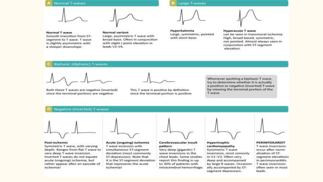 Abnormalities of t wave | PPTX