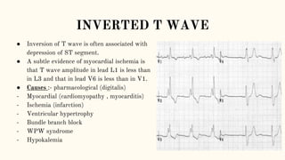 Abnormalities of t wave | PPT