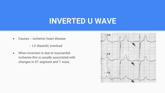 Abnormalities of u wave | PPT