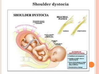 Abnormal Labor - obstructed labour and dystocia | PPT