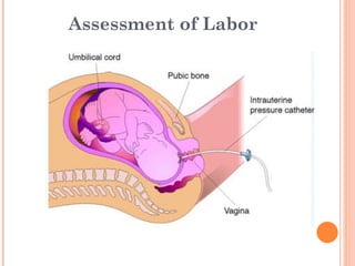Abnormal Labor - obstructed labour and dystocia | PPT