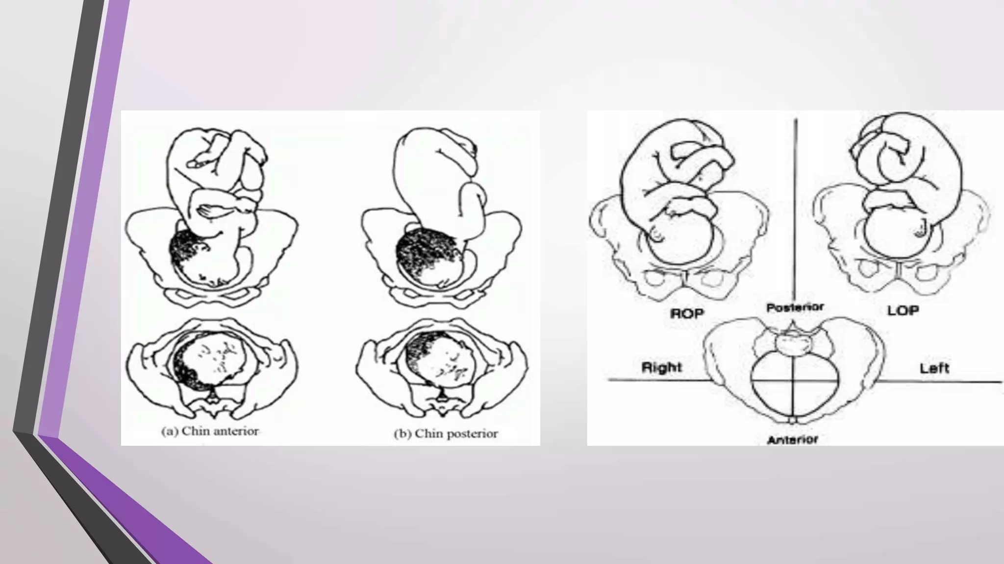 ABNORMAL LABOUR | PPTX