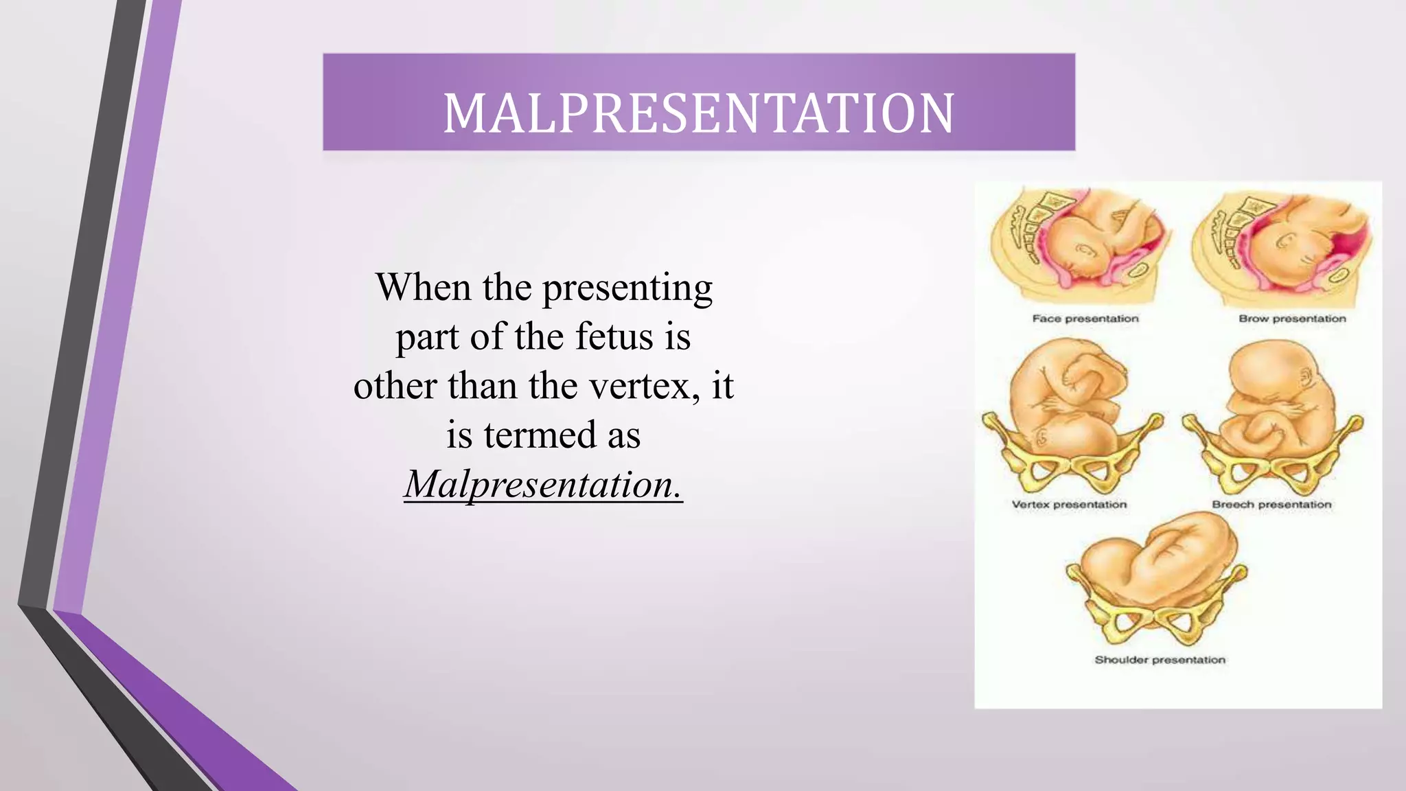 ABNORMAL LABOUR | PPTX