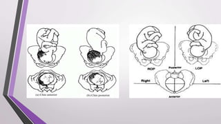 ABNORMAL LABOUR | PPTX