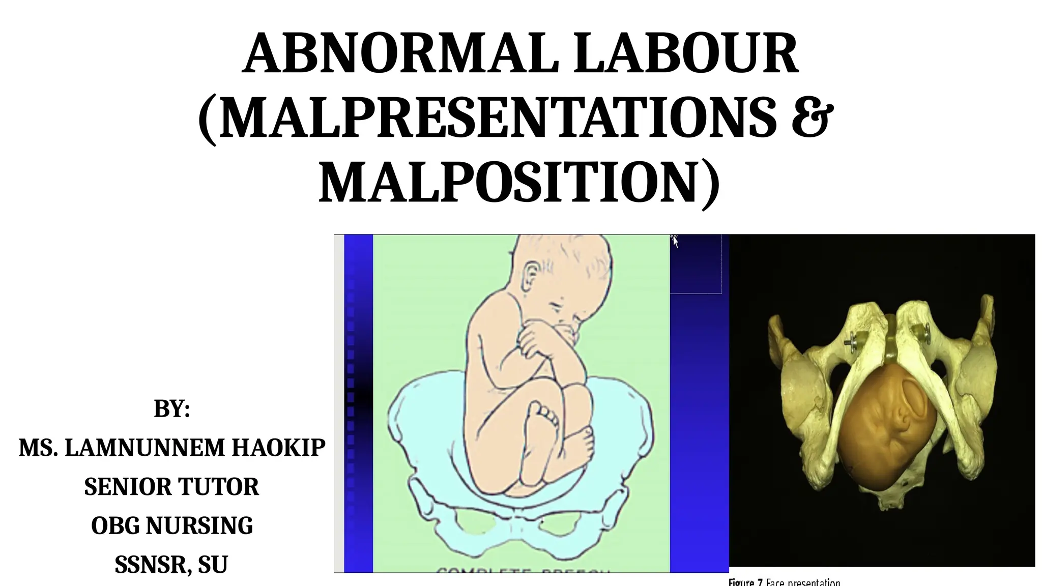 ABNORMAL LABOUR MALPRESENTATIONS & MALPOSITION (1) (1).pptx