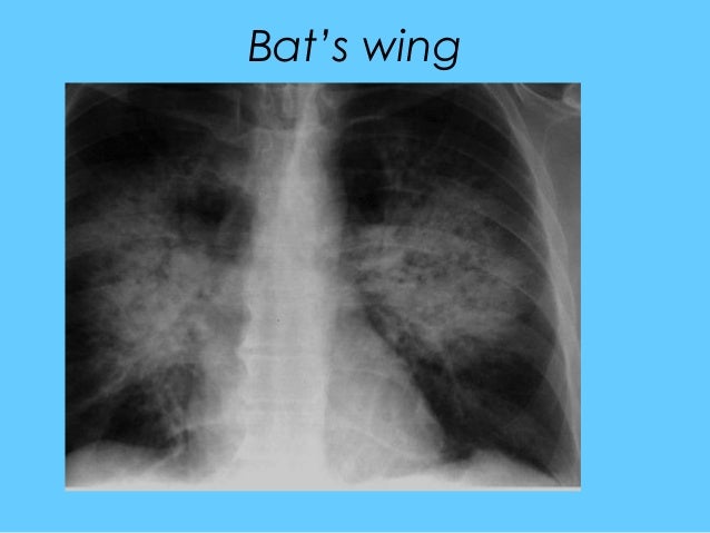 abnormal chest xray ppt