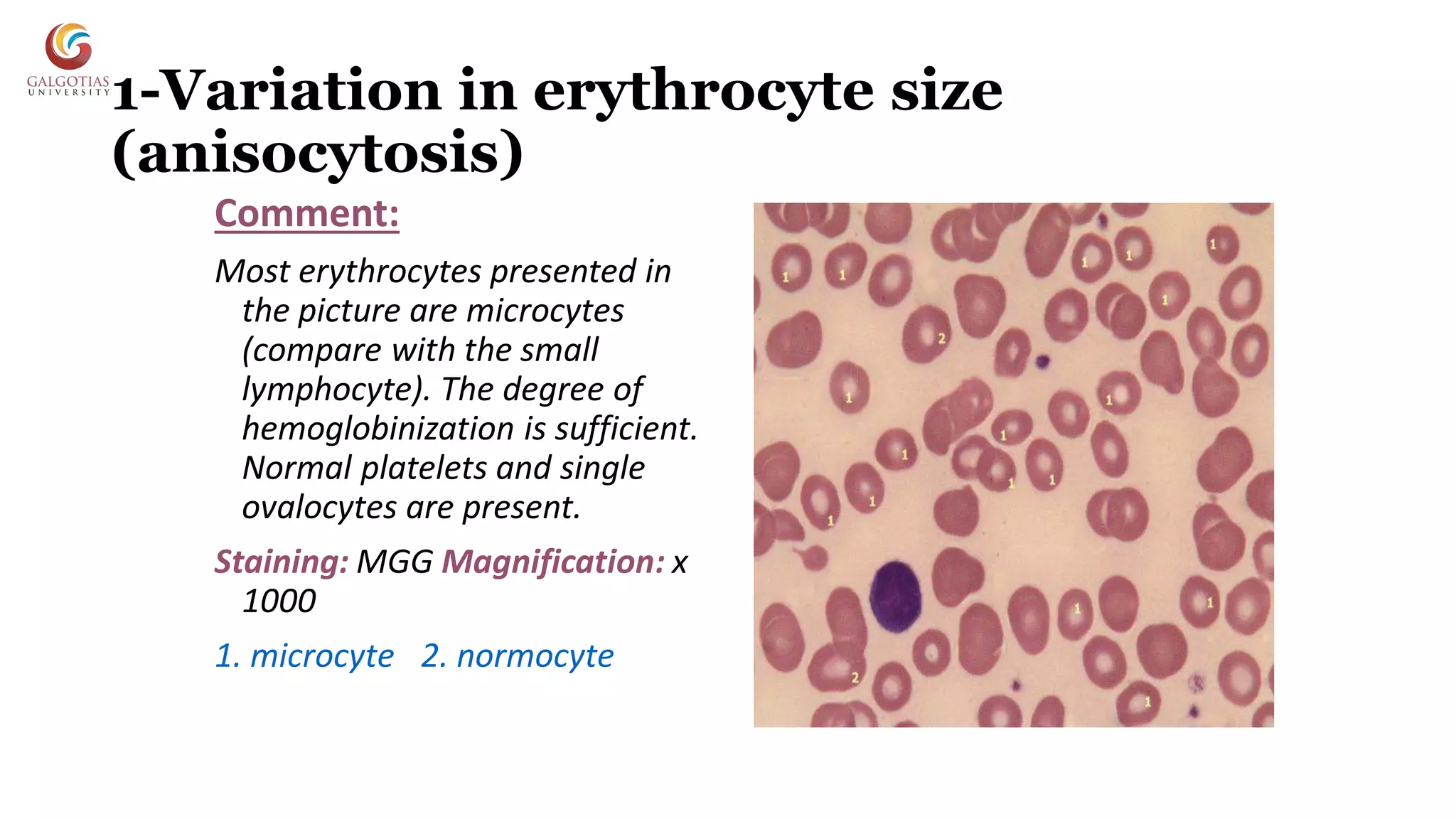 Abnormal morphology of rbc notes | PDF