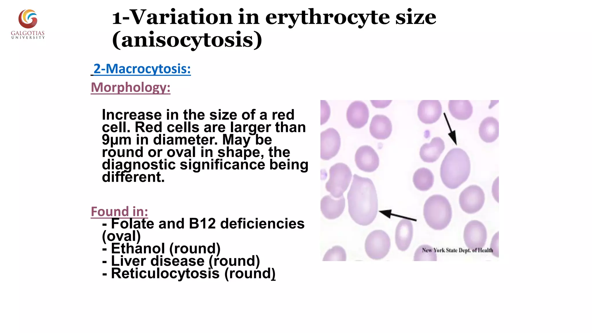 Abnormal morphology of rbc notes | PDF