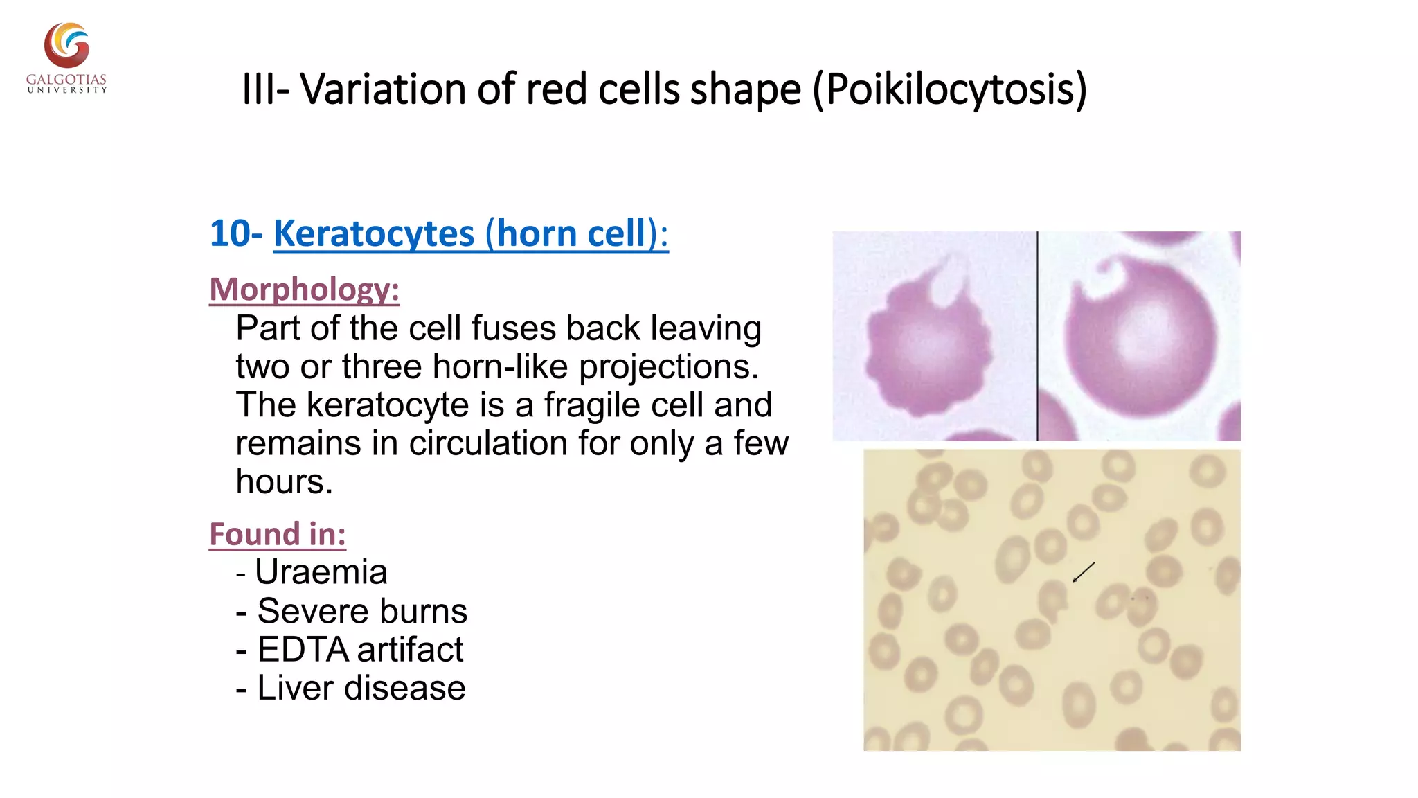 Abnormal morphology of rbc notes | PDF