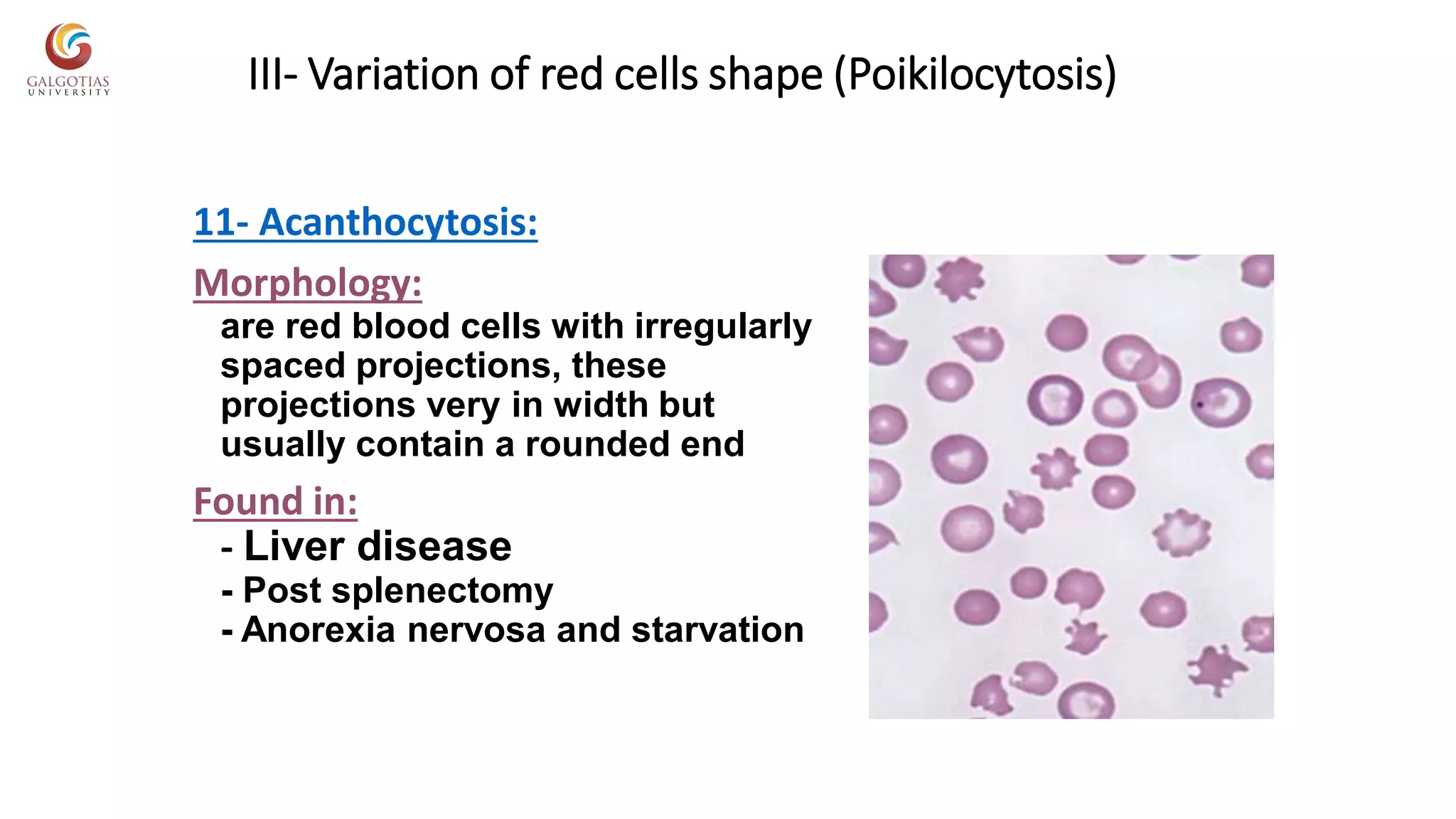 Abnormal morphology of rbc notes | PDF
