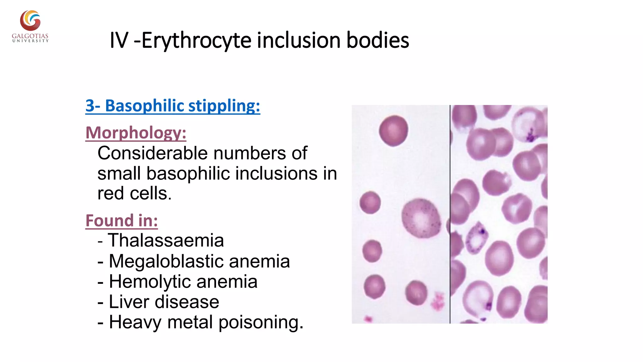 Abnormal morphology of rbc notes | PDF