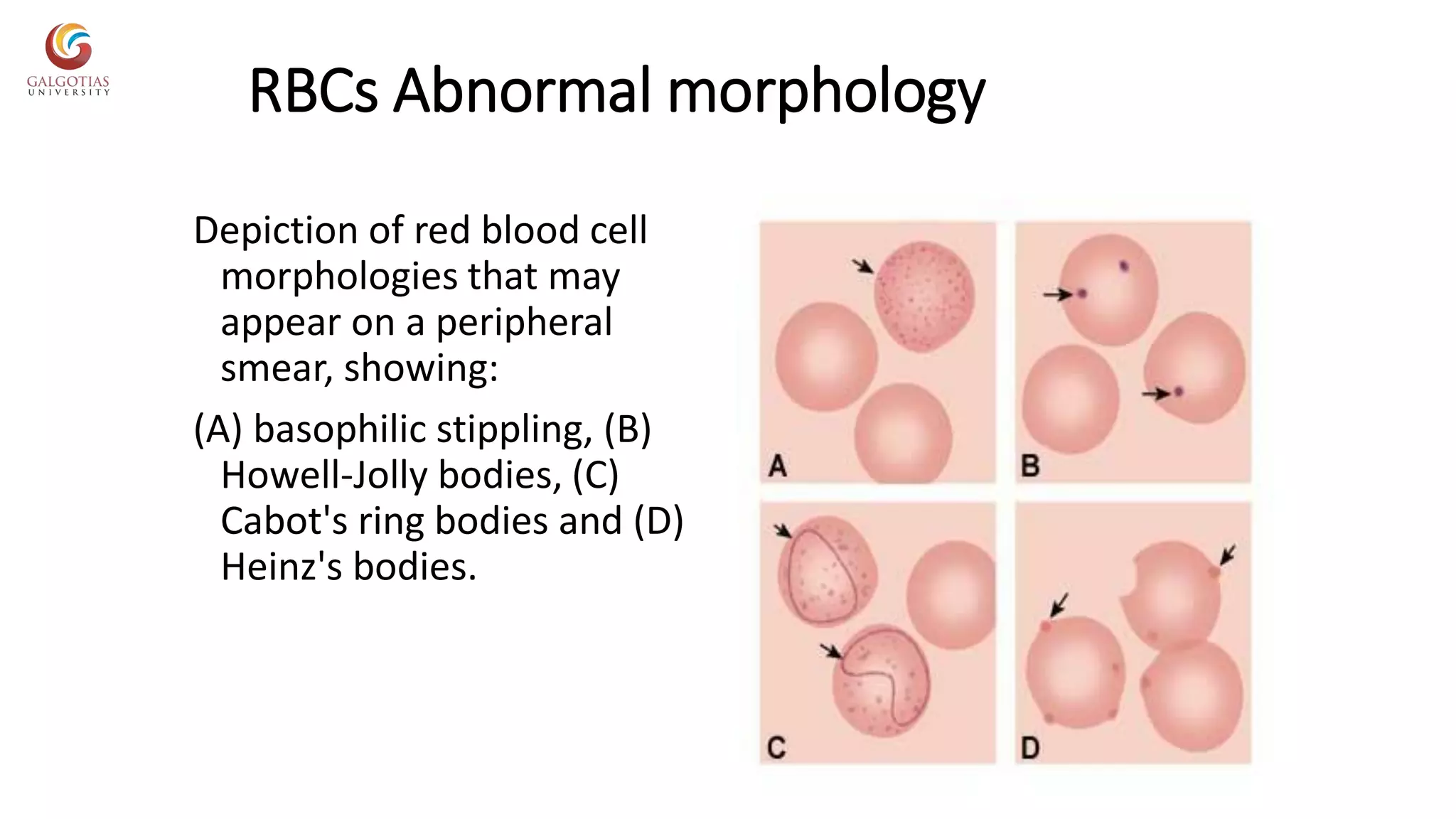 Abnormal morphology of rbc notes | PDF