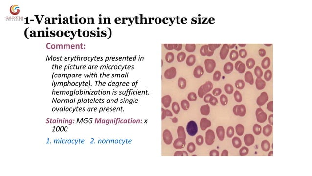 Abnormal morphology of rbc notes | PDF