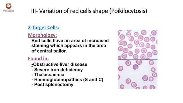 Abnormal morphology of rbc notes | PDF