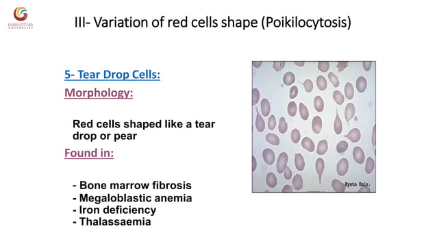 Abnormal morphology of rbc notes | PDF