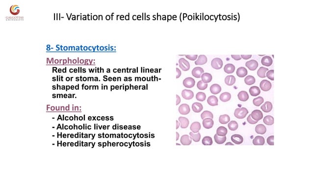 Abnormal morphology of rbc notes | PDF