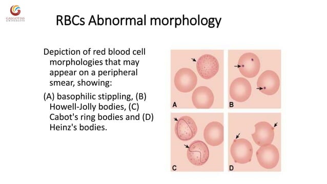 Abnormal morphology of rbc notes | PDF