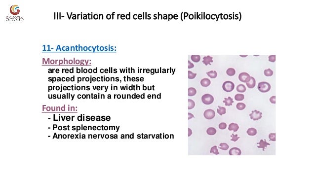 Abnormal morphology of rbc notes