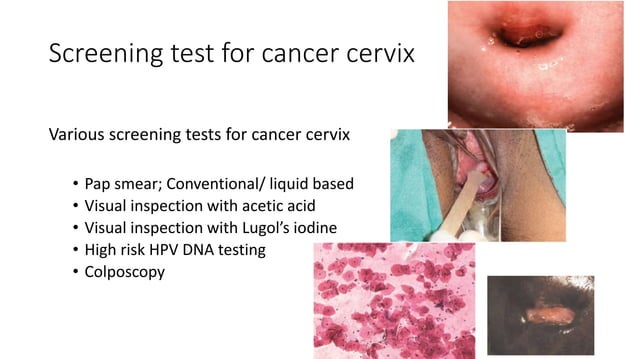 Management of Abnormal Pap Smear .pptx
