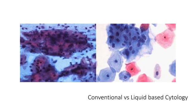 Management of Abnormal Pap Smear .pptx