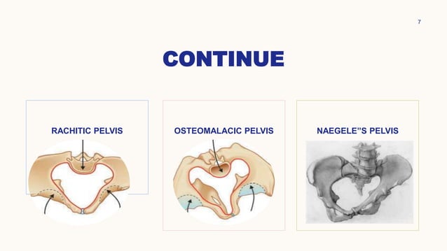 Abnormal pelvis.pptx