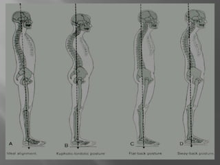 Abnormal posture in human body biomechanics.pdf