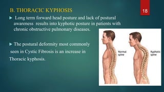 Abnormal posture in rs | PPTX