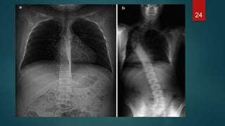 Abnormal posture in rs | PPTX