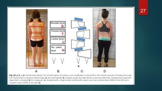 Abnormal posture in rs | PPTX
