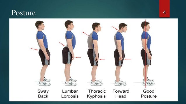 Abnormal posture in rs