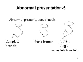 Abnormal Presentation Labor And Delivery