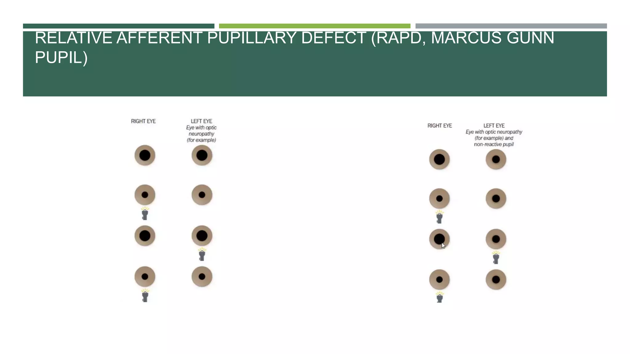 Abnormal pupil reactions - mehedi hasan | PPTX